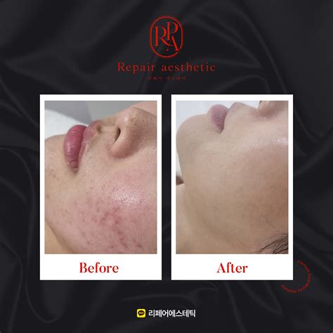 울산피부관리 리페어에스테틱 대표원장 한 유주 여드름 흉터 맛집 💕 고객님 얼굴보고 따라오신분들만해도 수두룩 걸어다니는 모델 🥹 지금은 맞춤관리로 유지중인지 N년째 🤭