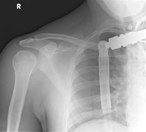 Radiopaedia Case Posterior Glenohumeral Joint Dislocation Id 80397