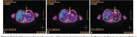 Figure 8 From Metastatic Pleomorphic Dermal Sarcoma Involving Tonsil