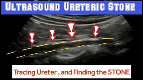 Ureteric Calculus Ultrasound Tracing And Finding Ureteric Stone Youtube