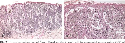 Figure 1 From Melanoma Arising In Segmental Nevus Spilus Detection By Sequential Digital