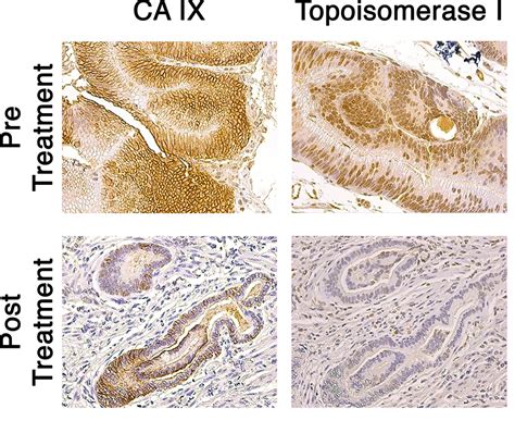 Nanoparticle Based Cancer Therapies Shown To Work In Humans Caltech Edu