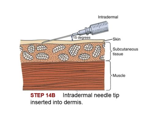 Administering Intradermal Injections Flashcards Quizlet