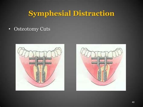Distraction Osteogenesis In Orthodontics Pptx