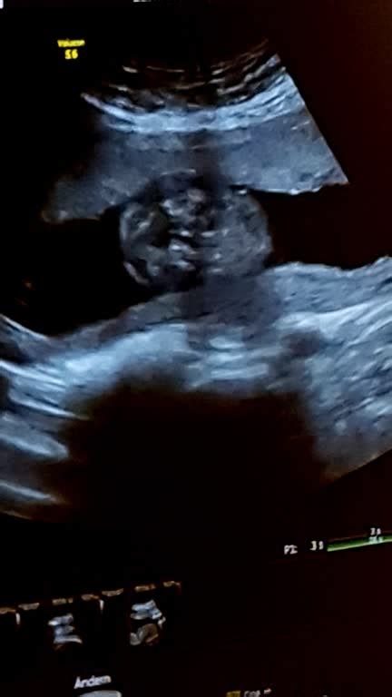 Ovarian Ultrasound Videos And Hd Footage Getty Images