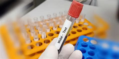 Typhoid Fever Diagnosis Using Antigen Detection Methods In Clinical Settings