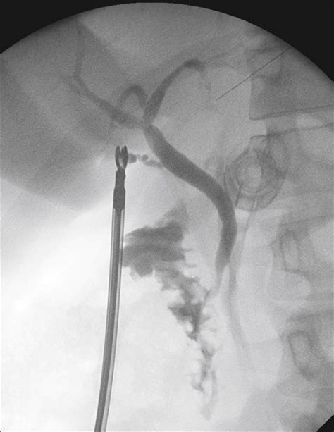 Gallbladder And Biliary Tree Clinical Tree
