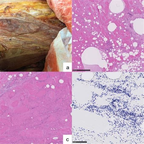 Necrotizing Fasciitis A Macroscopic View Of Debridement Site B C Download Scientific