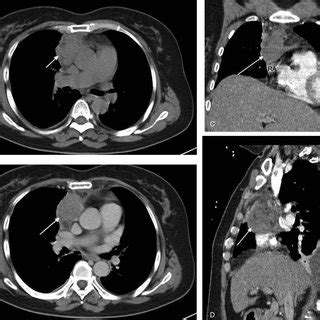 The Ct Scan Of The Mass Arrow In The Anterior Mediastinum A It Is