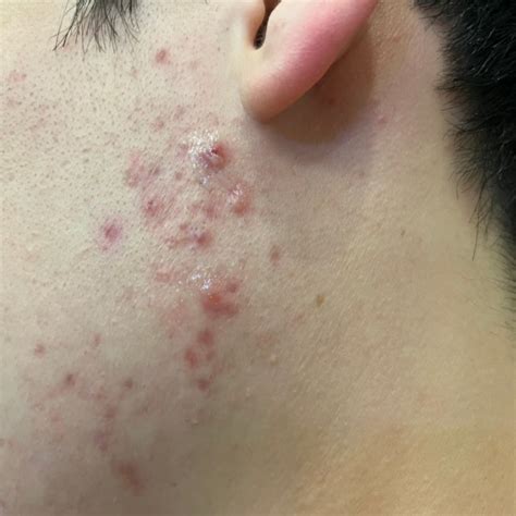 30대 성인 화농성여드름 치료 일기 3내돈내산 네이버 블로그