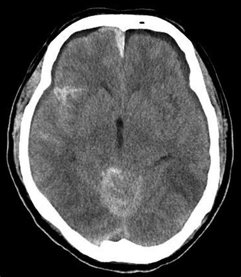 Head Ct Shows Subarachnoid Hemorrhage Acute Subdural Hematoma And Download Scientific Diagram