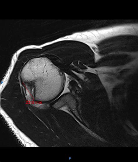 Radiopaedia Case Off Track Hills Sachs Defect Id 88716 Study 105441
