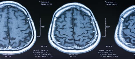 Brain Activity May Id Bipolar Patients At Risk Of Suicide Mpr