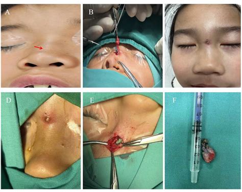 Frontiers Pediatric Nasal Dermoid Sinus Cysts Advances In