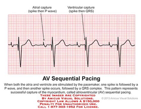 Av Sequential Pacing
