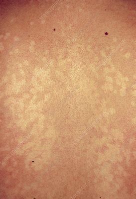 What Causes Light Spots On Brown Skin