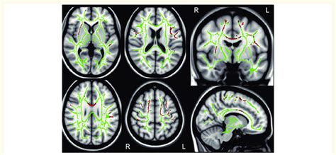 Results Of The Tract Based Spatial Statistics Analysis Of Fractional Download Scientific