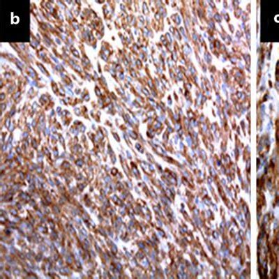 A Pathological Reports With Malignant GIST With Mitosis On 400 HPF B
