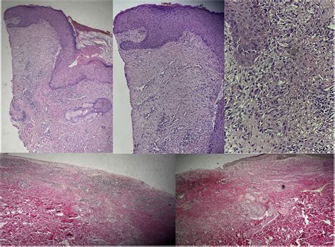 Pyoderma Gangrenosum In A Severely Burned Patient Medicina Intensiva
