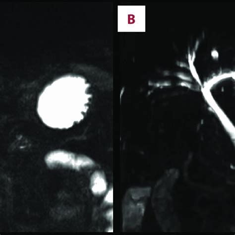 Magnetic Resonance Cholangiography Mrc Imaging Findings A Mrc Download Scientific Diagram