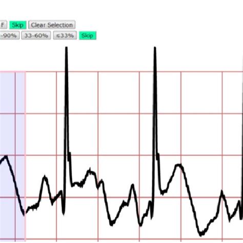 Extract Fetal Ecg From Abdominal Ecg To Maternal Ecg Download
