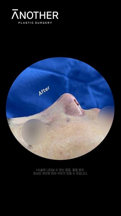 코재수술 들린코 짧은코 짧고 들린코의 변화 Youtube