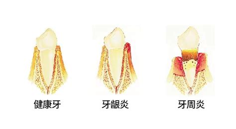 牙龈炎、牙周炎怎么分辨？ 知乎