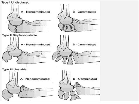 Olecranon Fracture Classification