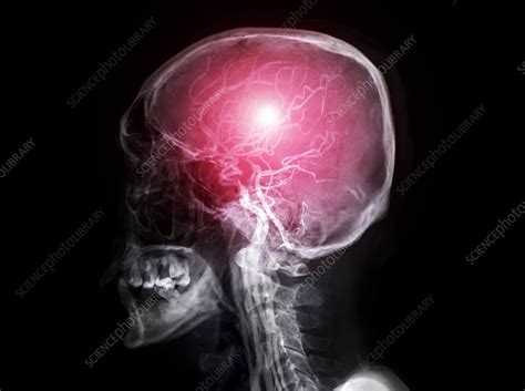 Cerebral Arteries Mri Angiogram Stock Image F Science