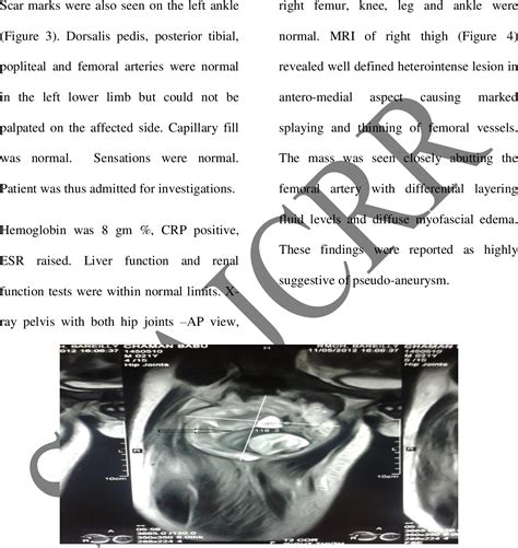 Promethazine Hydrochloride 125 Mg Rectal Suppository Phenergan