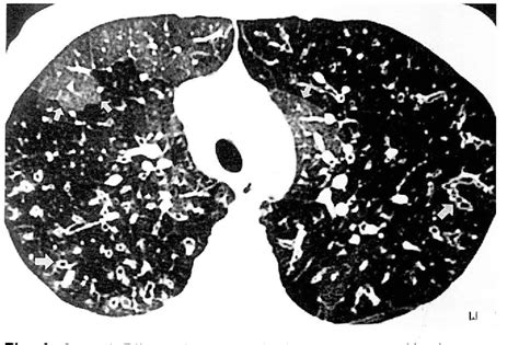 PDF Bronchiectasis In Diffuse Panbronchiolitis High Resolution CT Assessment Semantic Scholar