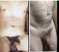 Foreskin Restoration LPSG