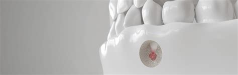 Apicoectomy Surgery Dental365