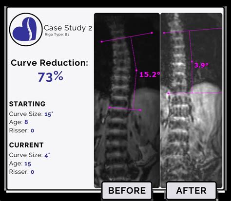 Results By Curve Reduction Scoliosis Care Centers