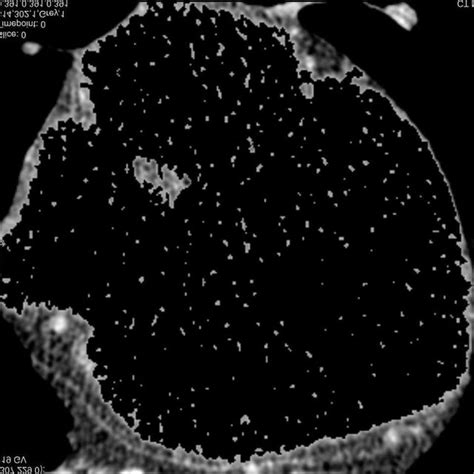 preprocessing steps a non contrated image b muscle segmentation