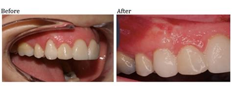 Gingival Graft Alloderm