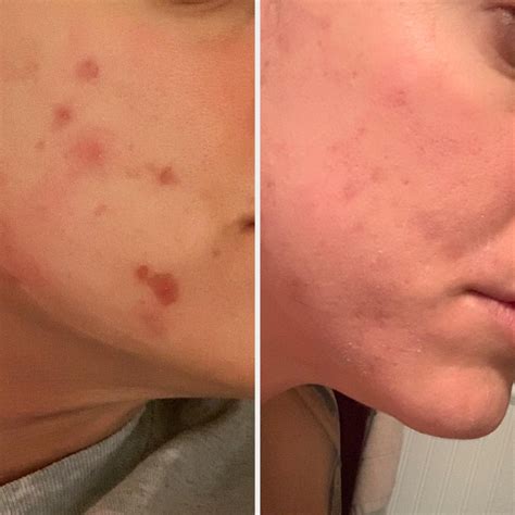 Pimple Patches Before And After Pea Vie