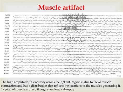 Eeg Artifacts