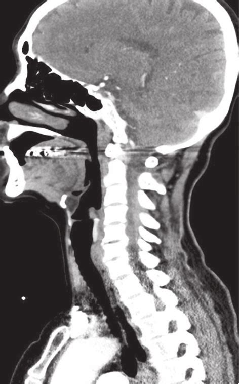 Contrast Enhanced Ct Neck Angiogram Download Scientific Diagram