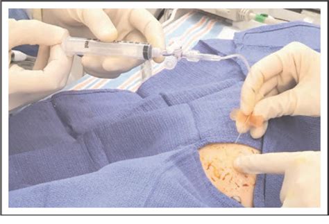 Figure 1 From Needle Aspiration Of The Pneumothorax Semantic Scholar