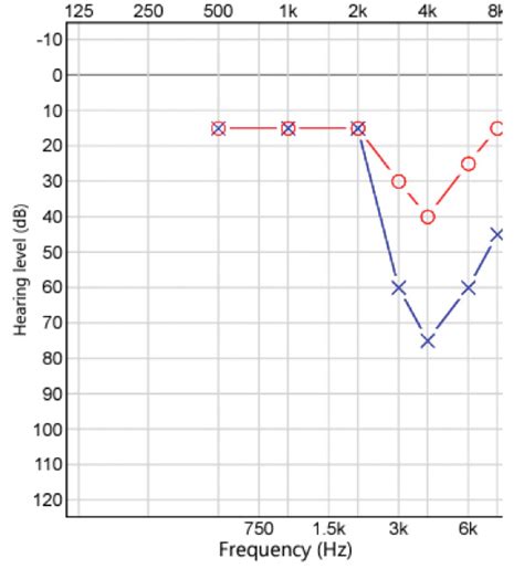 Audiogram Graph At Hamish Gellatly Blog