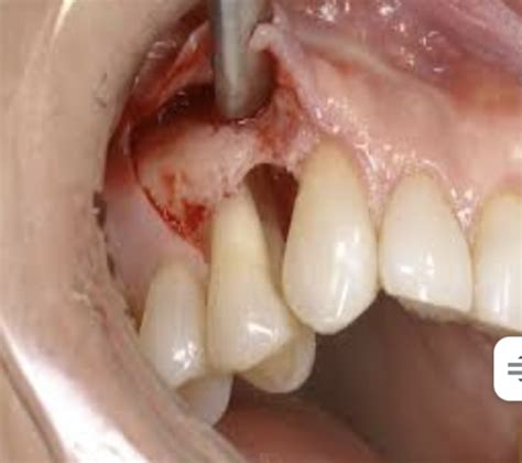 Maxillary Premolars Flashcards Quizlet