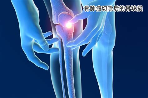 骨肿瘤切除后的骨缺损可以长出来吗图片 39健康网
