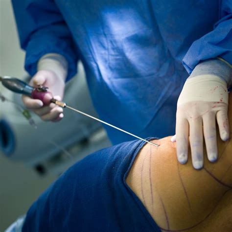 What To Expect During A Liposuction Procedure Call Now