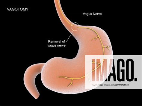 Vagotomy And Antrectomy