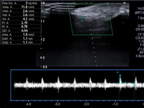Follow Up Of Treatment Response With Dynamic Doppler Ultrasound In Raynaud Phenomenon Ajr
