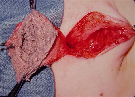 Umbilicus Surgery Photos