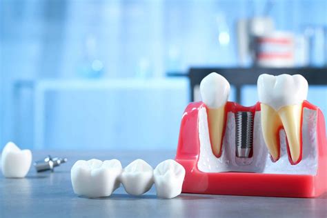 The Osseointegration Process Paul Covell Dds