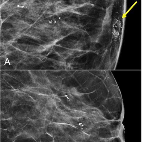 Radiologic Patterns In Gynecomastia A Nodular B Dendritic C Diffuse Download Scientific Diagram