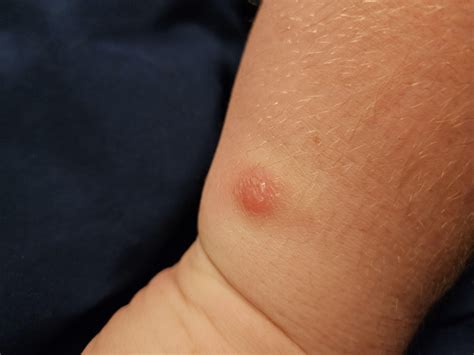 Spider Bite Rspiderbites